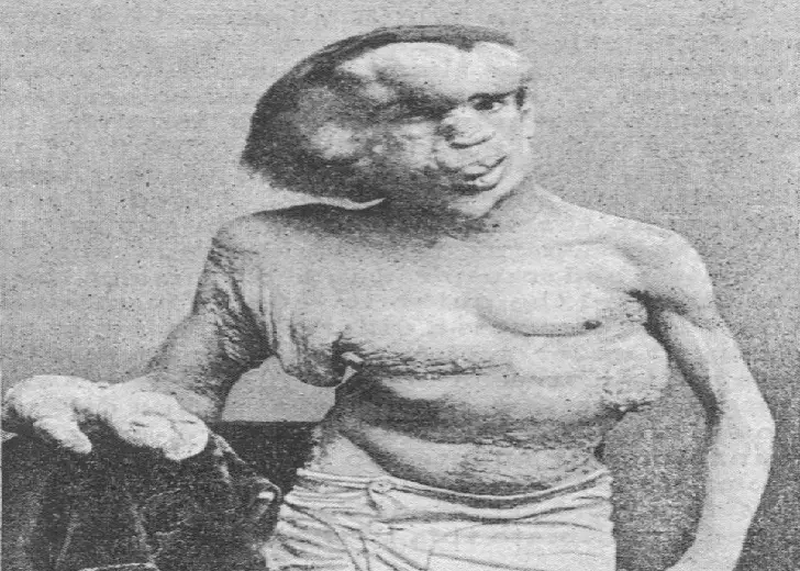 Joseph Merrick - The Elephant Man, Age, Married and Children
